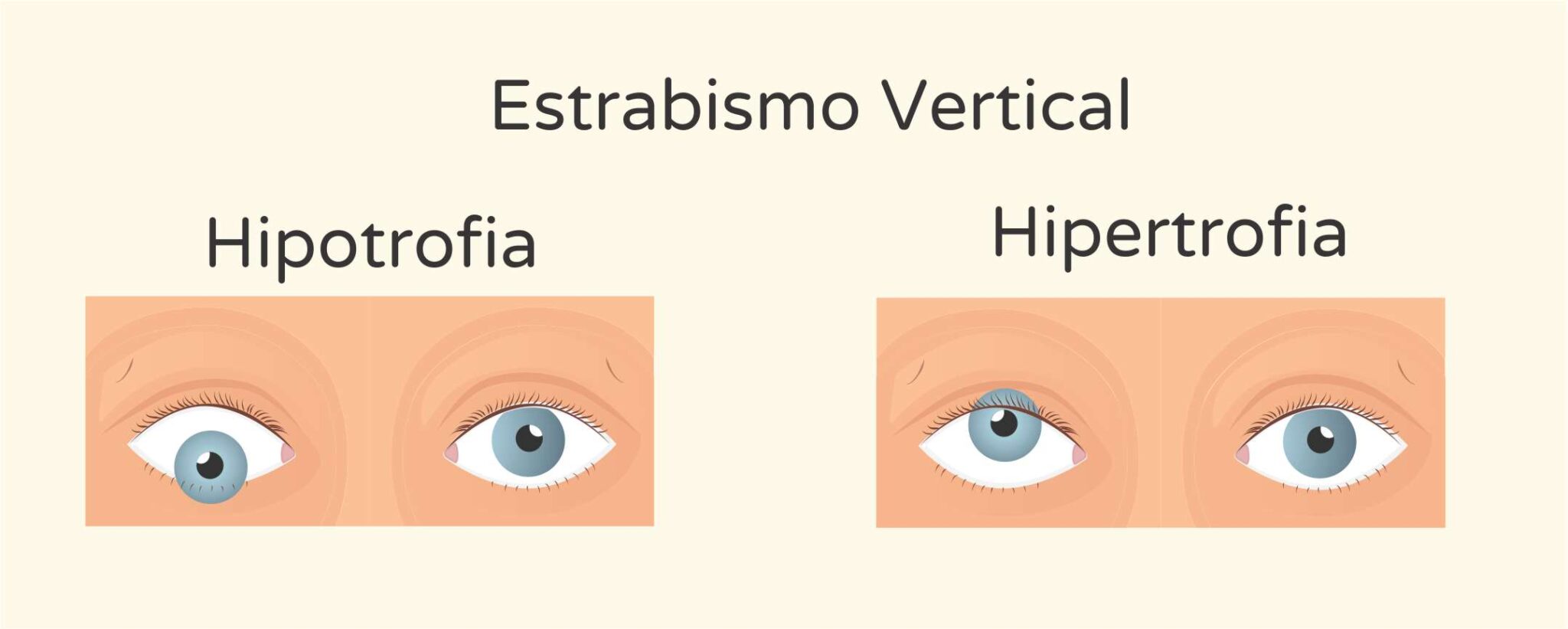 O que é estrabismo? – Instituto de olhos de Florianópolis