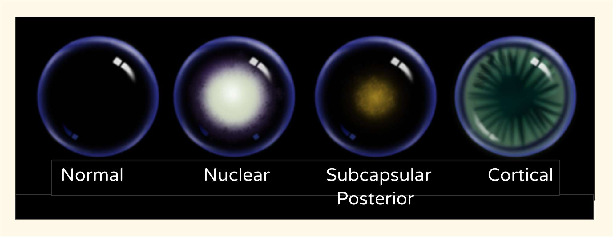 Entendendo sobre catarata: Dos sintomas ao tratamento – Instituto de ...