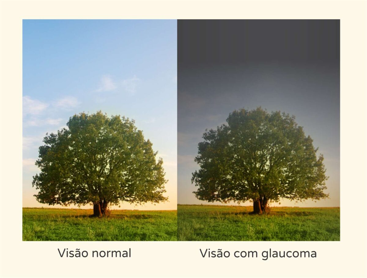 A pressão ocular e o risco de glaucoma – Instituto de olhos de ...