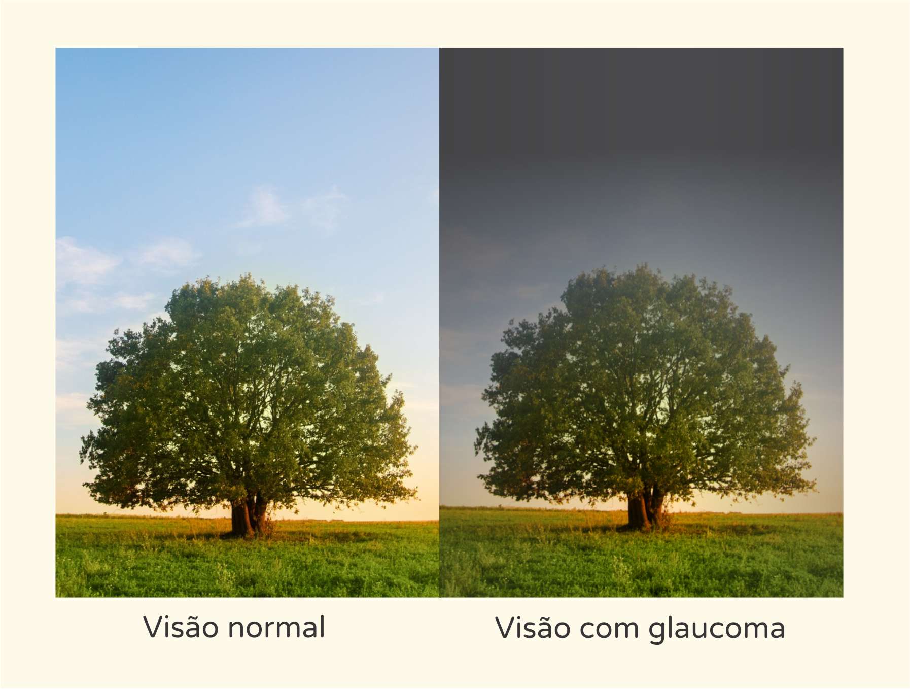 A pressão ocular e o risco de glaucoma – Instituto de olhos de ...